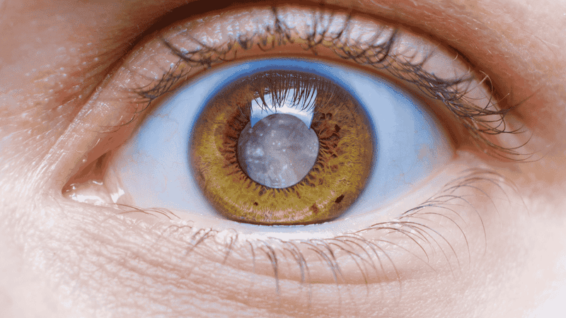 Glaucoma de Ângulo Fechado: O Risco de Cegueira Súbita e o Tratamento ...